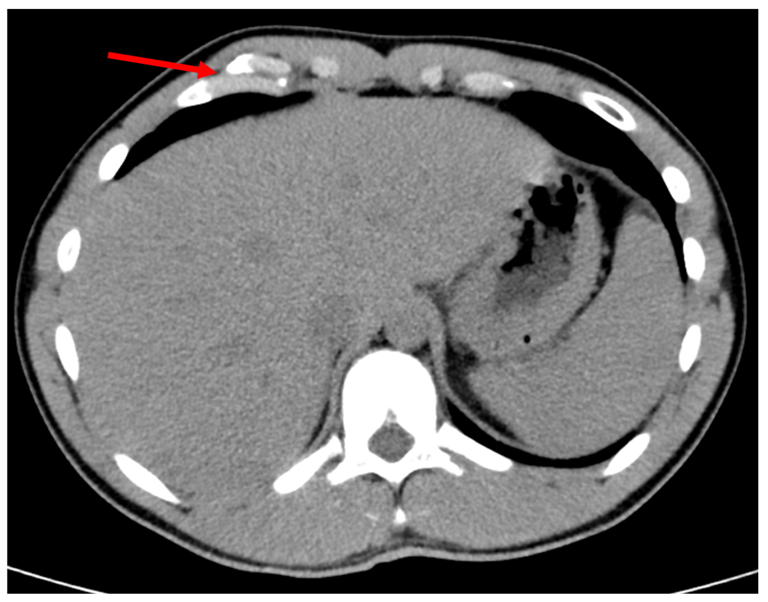 Epidemiology of Symptomatic Non-Union/Malunion Rib Fractures