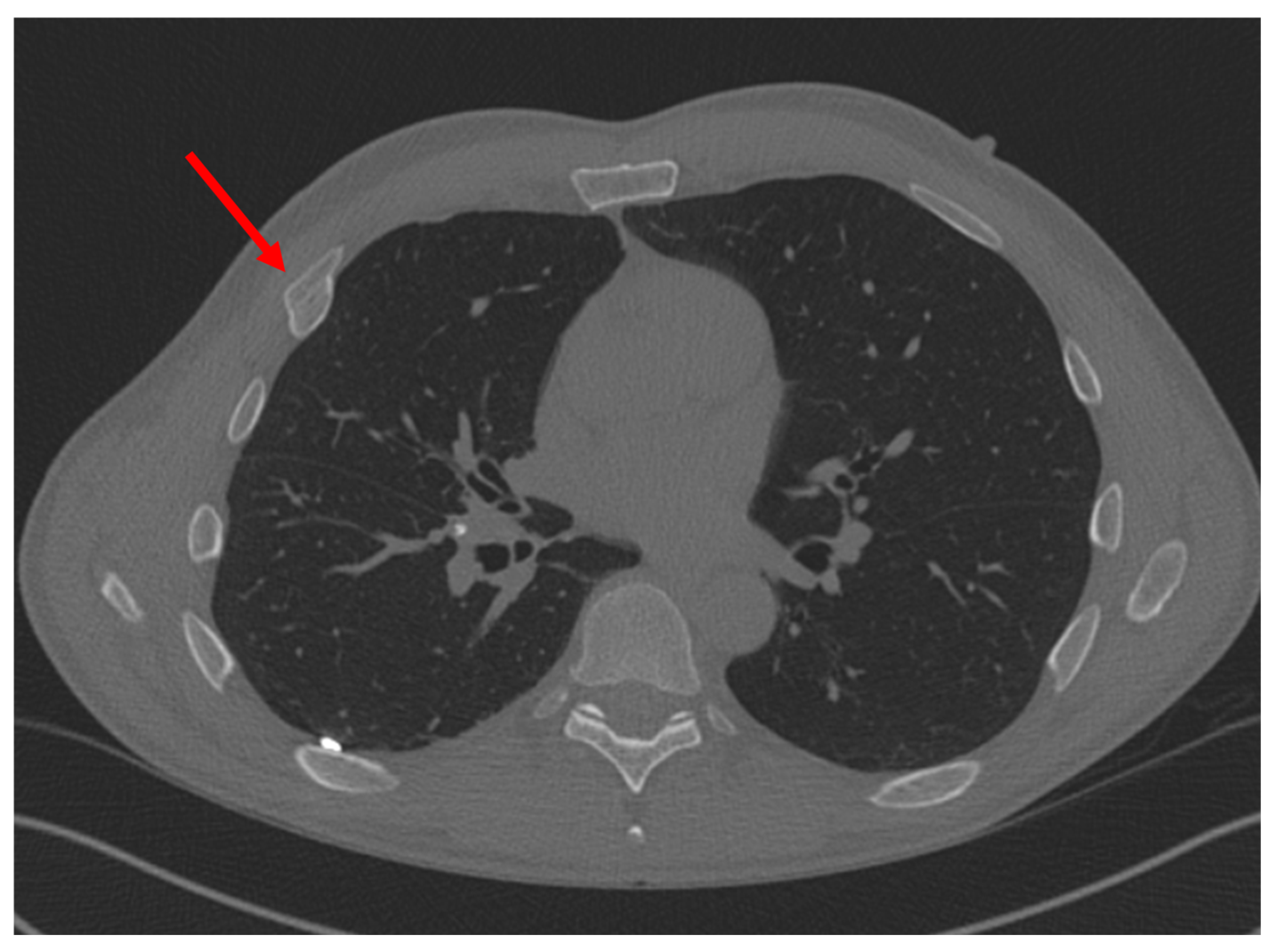 Epidemiology of Symptomatic Non-Union/Malunion Rib Fractures