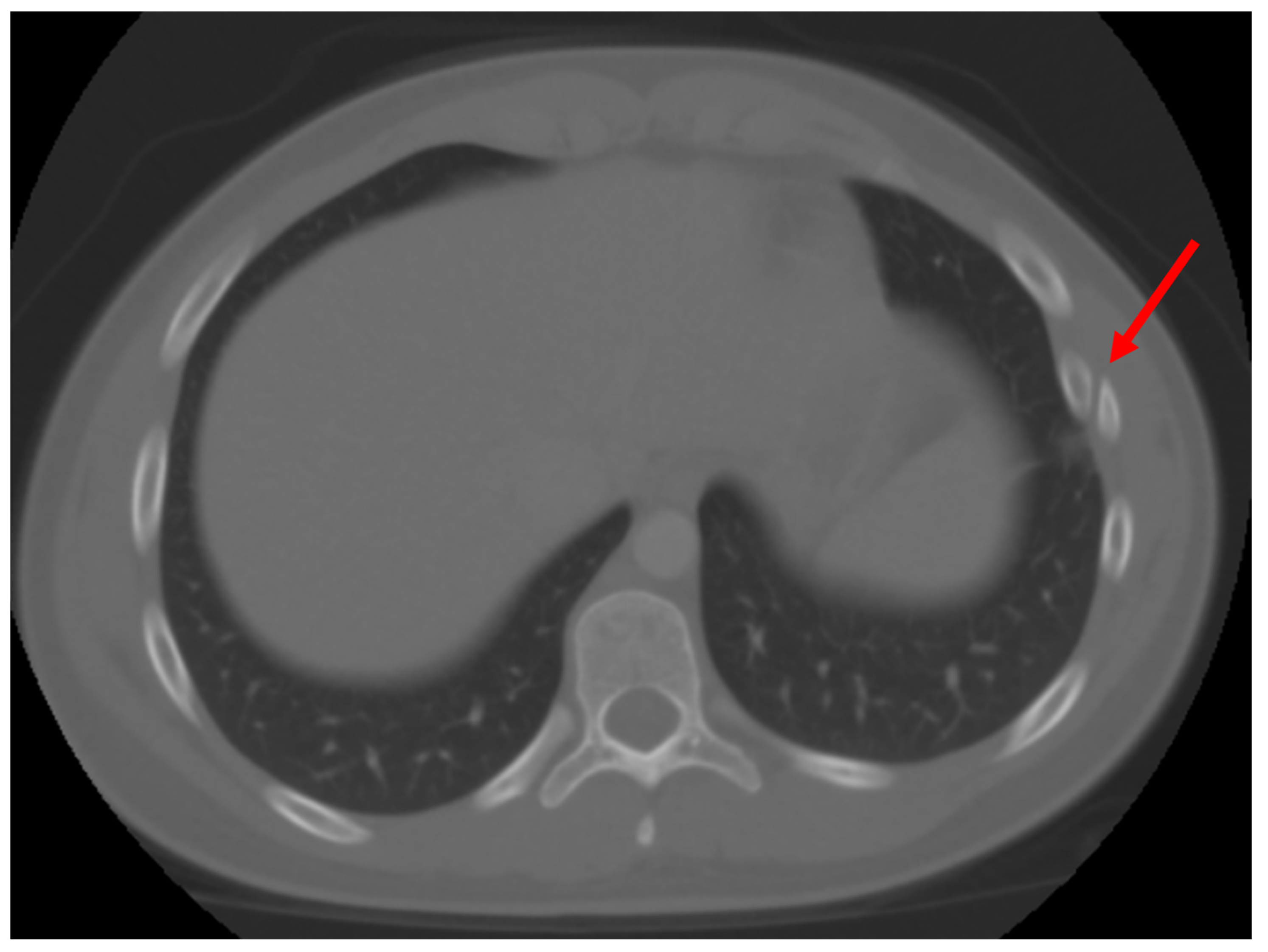 Epidemiology of Symptomatic Non-Union/Malunion Rib Fractures