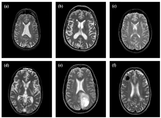 Multi-Class Disease Classification in Brain MRIs Using a Computer-Aided ...