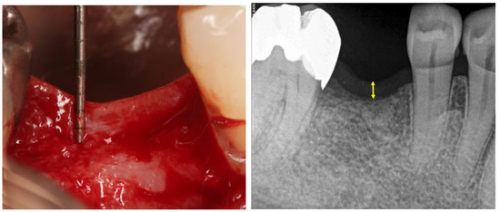 Influence of Mucosal Thickness, Implant Dimensions and Stability in ...