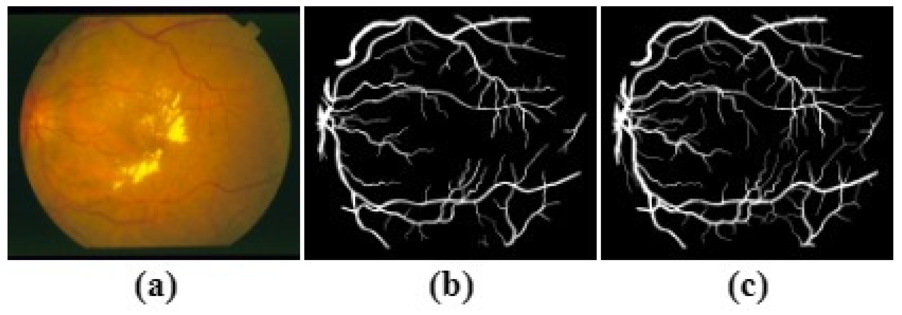 Retinal Blood Vessel Segmentation Using Hybrid Features and Multi-Layer ...