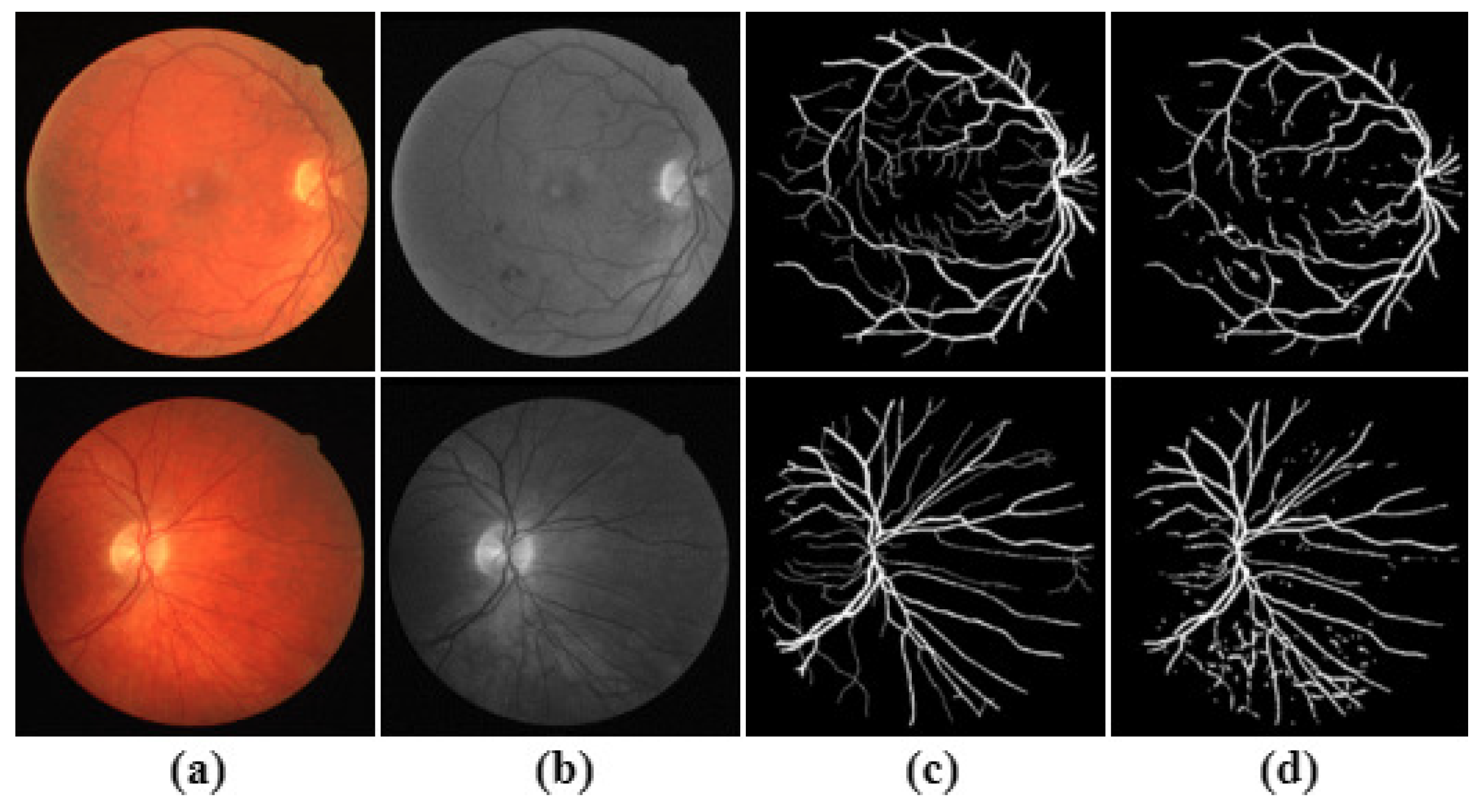 Retinal Blood Vessel Segmentation Using Hybrid Features and Multi-Layer ...