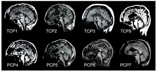 Symmetry | Special Issue : Symmetry and Asymmetry in Brain Behavior and ...