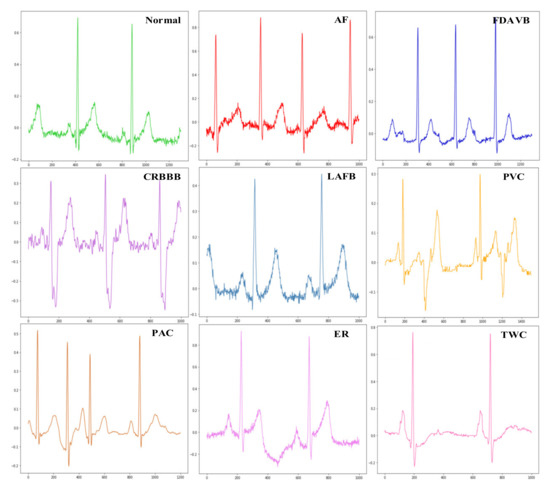 Symmetry | Free Full-Text | Automatic Classification System of Arrhythmias Using 12-Lead ECGs ...