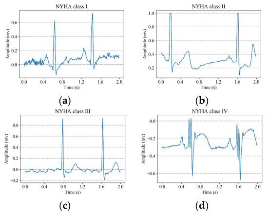 Classification of Congestive Heart Failure from ECG Segments with a ...