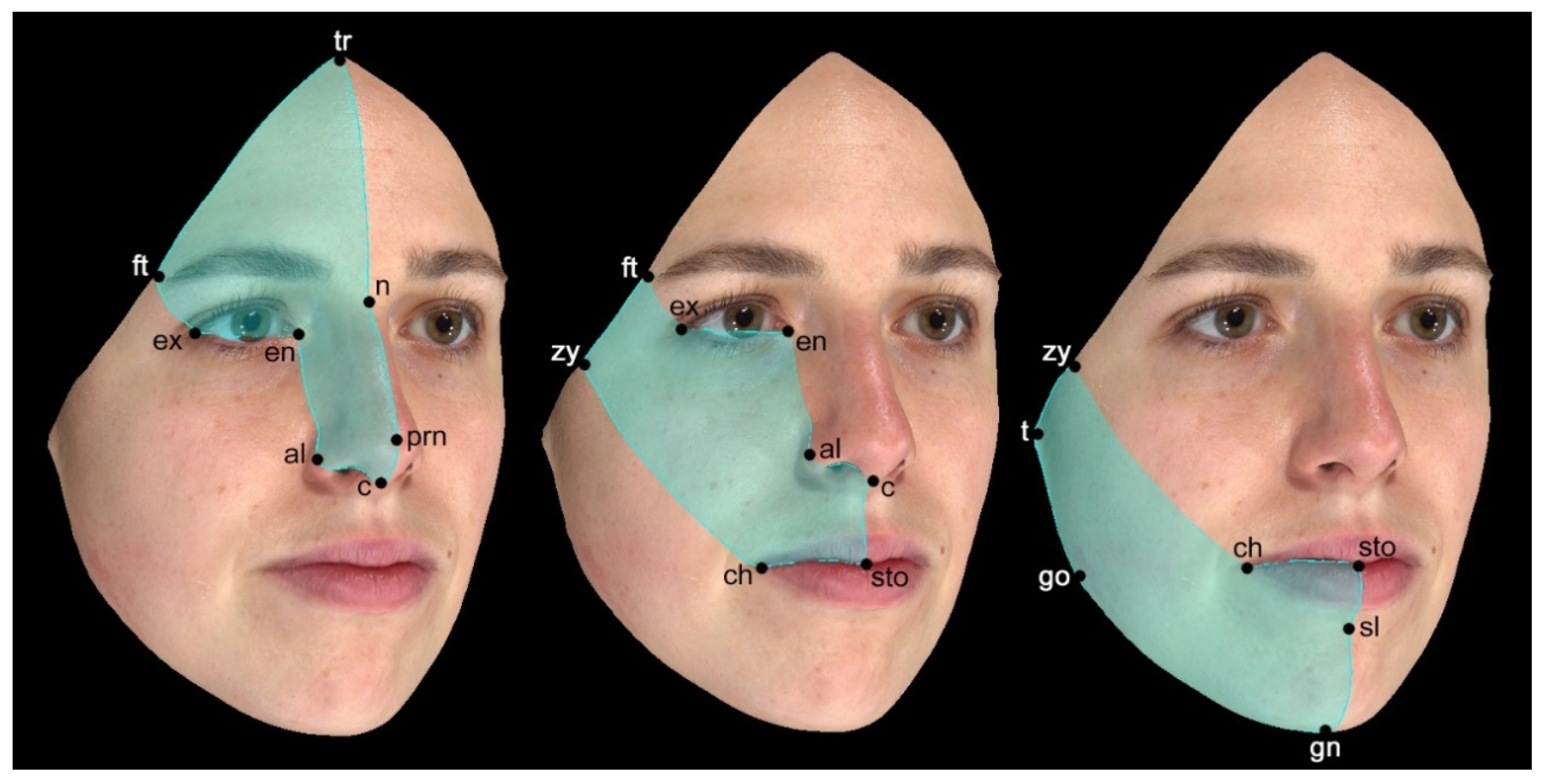 Efficacy of Autologous Fat Grafting in Restoring Facial Symmetry in ...