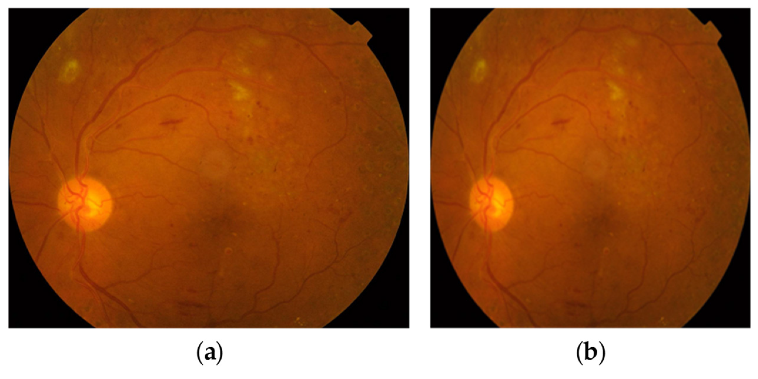 Severity Classification of Diabetic Retinopathy Using an Ensemble Learning Algorithm through ...