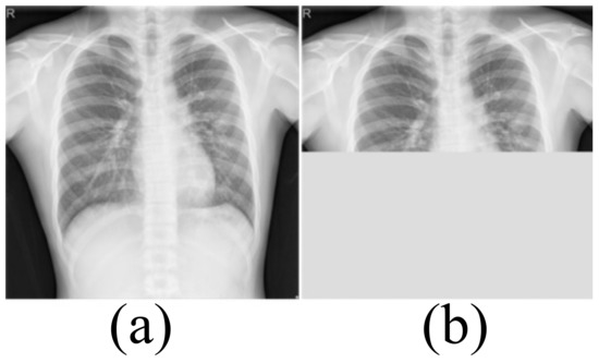 Automatic Lung Segmentation Algorithm on Chest X-ray Images Based on Fusion Variational Auto ...