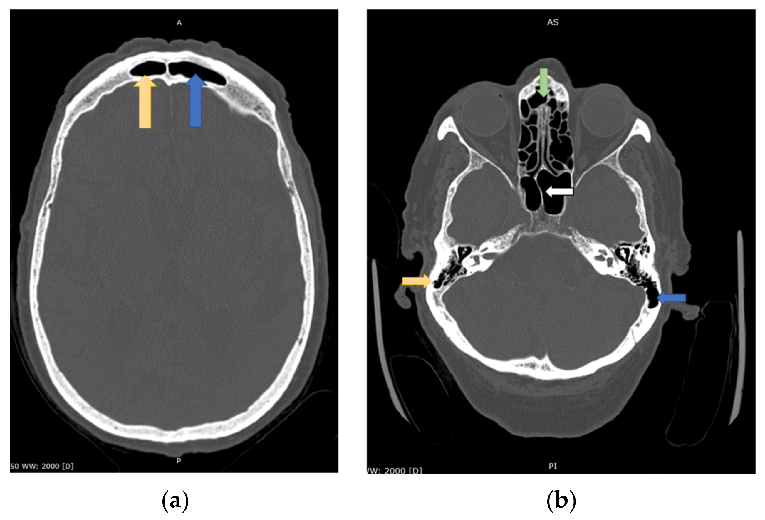 Symmetry of the Human Head—Are Symmetrical Models More Applicable in ...