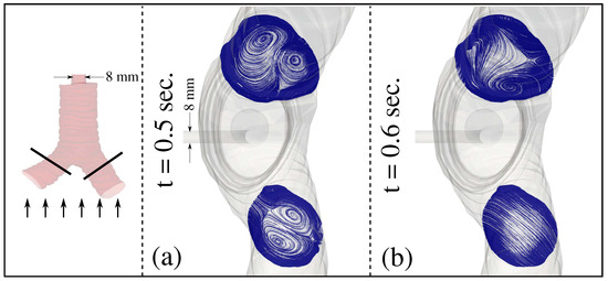 Endotracheal Tubes Design: The Role of Tube Bending