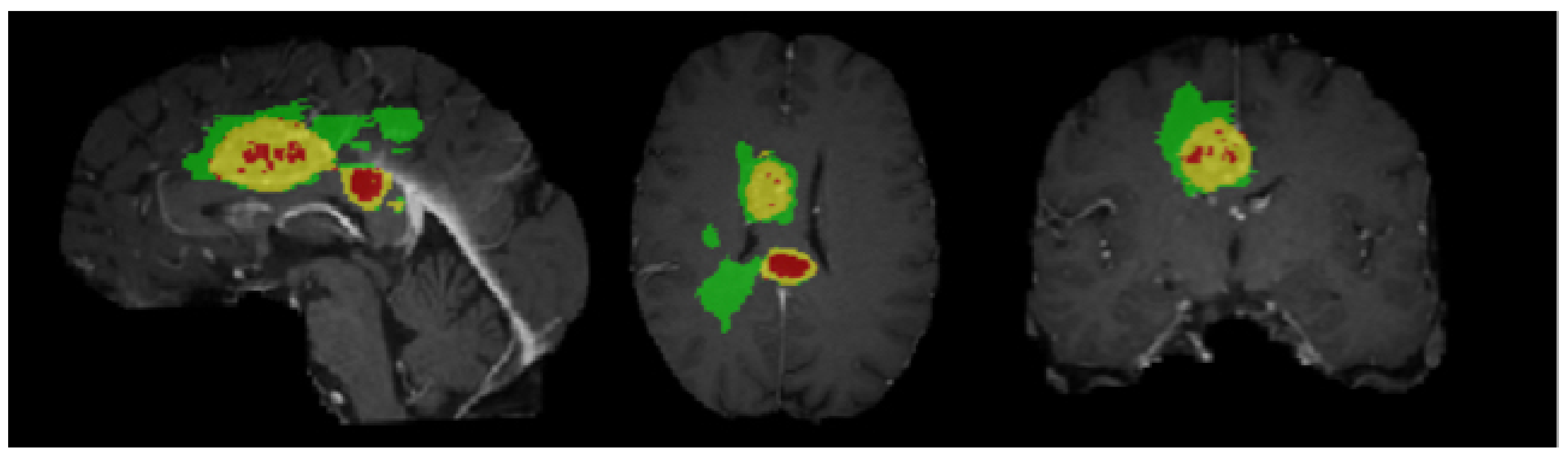 GenU-Net++: An Automatic Intracranial Brain Tumors Segmentation Algorithm on 3D Image Series ...