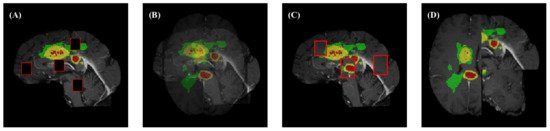 GenU-Net++: An Automatic Intracranial Brain Tumors Segmentation Algorithm on 3D Image Series ...