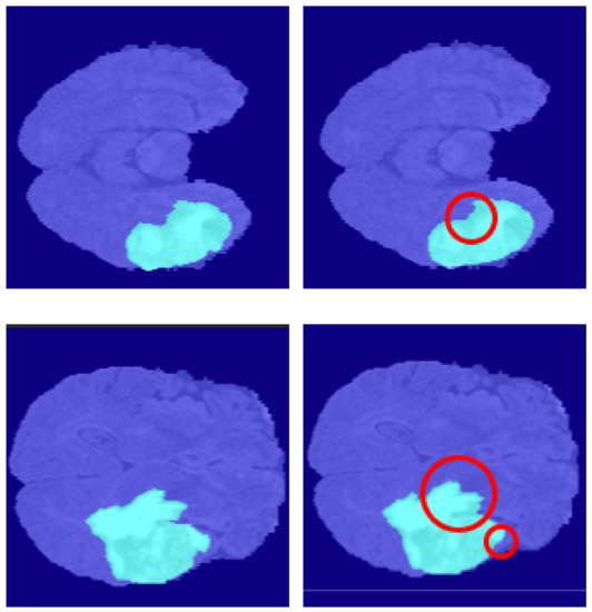 GenU-Net++: An Automatic Intracranial Brain Tumors Segmentation ...