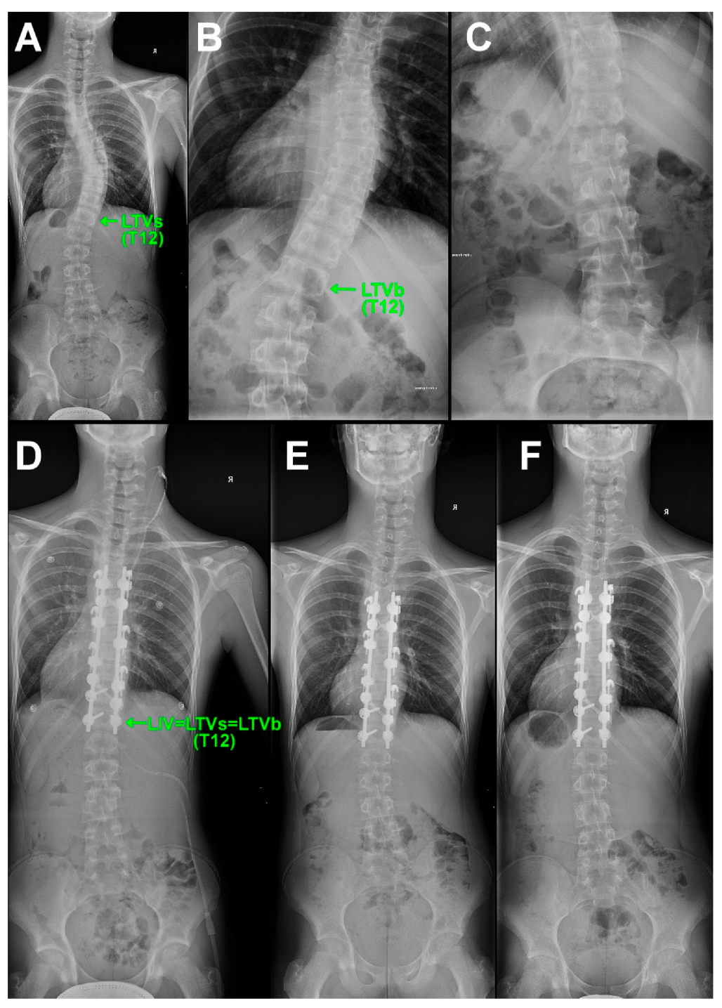The Role of Bending Films in the Lowest Instrumented Vertebra Selection ...