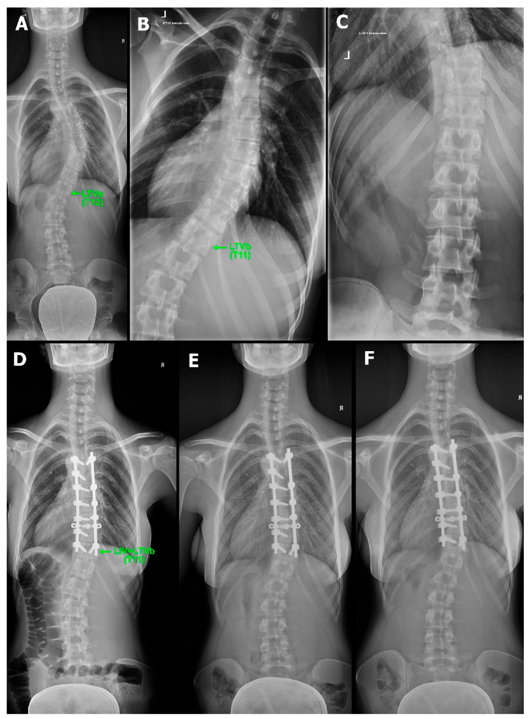 The Role of Bending Films in the Lowest Instrumented Vertebra Selection ...