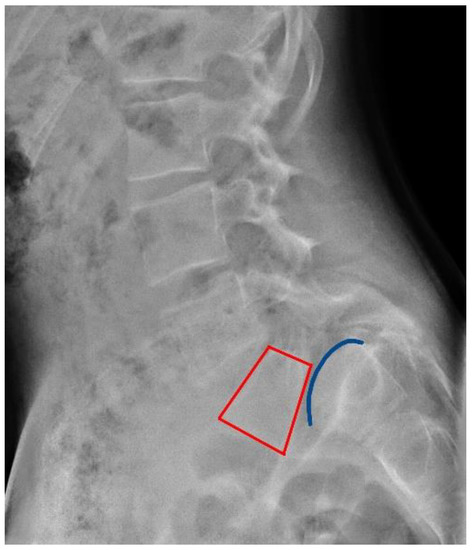 Vertebral Slip Morphology in Dysplastic Spondylolisthesis as a ...