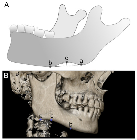Symmetry and Asymmetry of the Antegonial Notch