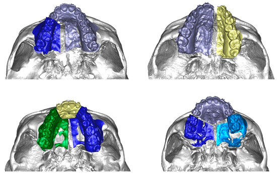 Orthodontic Perspective for Face Asymmetry Correction