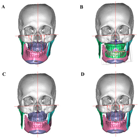 Orthodontic Perspective for Face Asymmetry Correction
