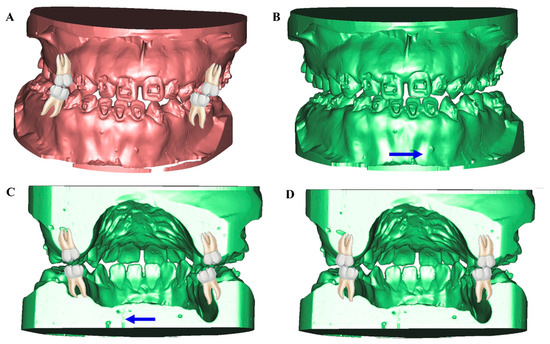 Orthodontic Perspective for Face Asymmetry Correction