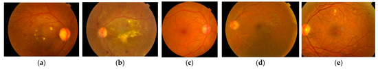 Diabetic Retinopathy Classification Using CNN and Hybrid Deep ...