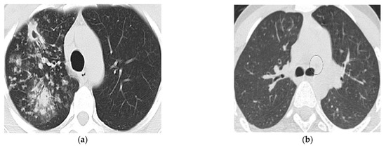 Machine Vision Approach for Diagnosing Tuberculosis (TB) Based on ...
