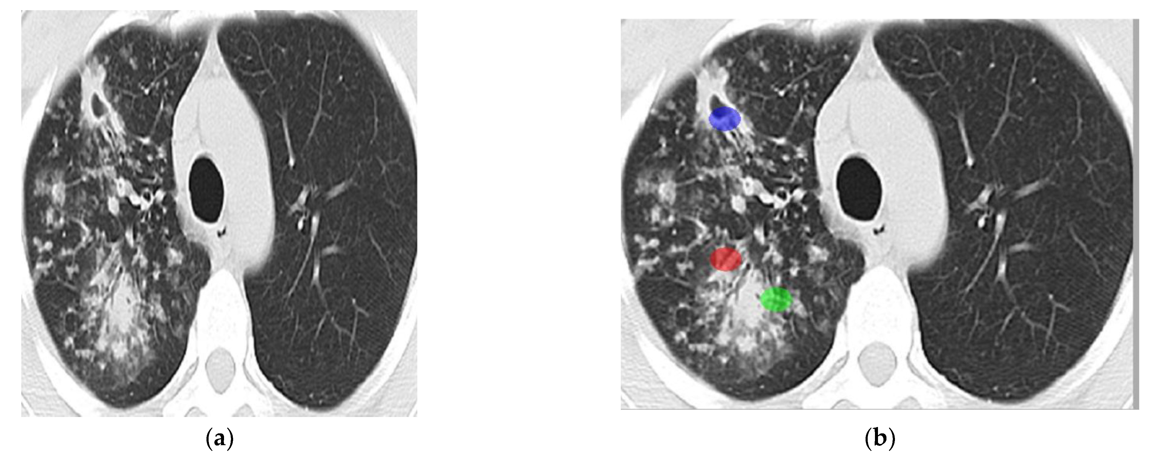 Machine Vision Approach for Diagnosing Tuberculosis (TB) Based on ...