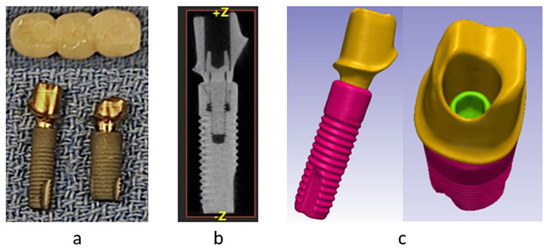 Finite Element Analysis of an Implant-Supported FDP with Different ...