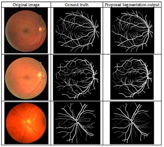 Outlier Based Skimpy Regularization Fuzzy Clustering Algorithm for Diabetic Retinopathy Image ...