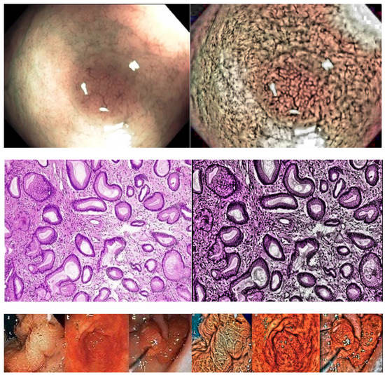 A Method for Local Contrast Enhancement of Endoscopic Images Based on ...