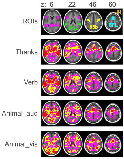 Concordance of Lateralization Index for Brain Asymmetry Applied to ...