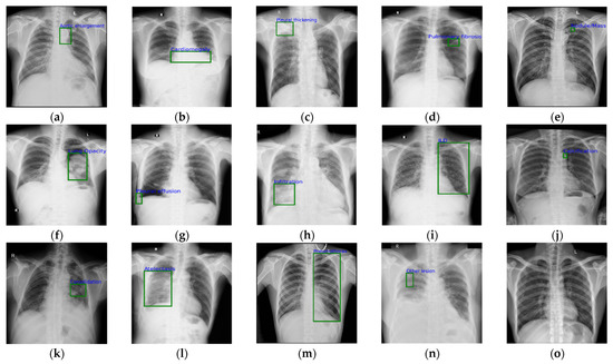 Anomaly Detection in Chest X-rays Based on Dual-Attention Mechanism and ...