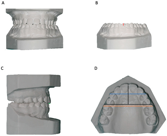 Relapse after Orthodontic-Surgical Treatment: A Retrospective ...