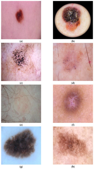 Symmetry in Privacy-Based Healthcare: A Review of Skin Cancer Detection ...