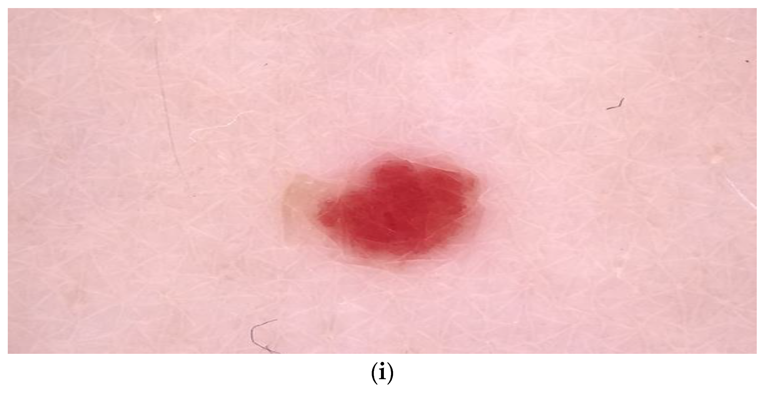Symmetry in Privacy-Based Healthcare: A Review of Skin Cancer Detection ...