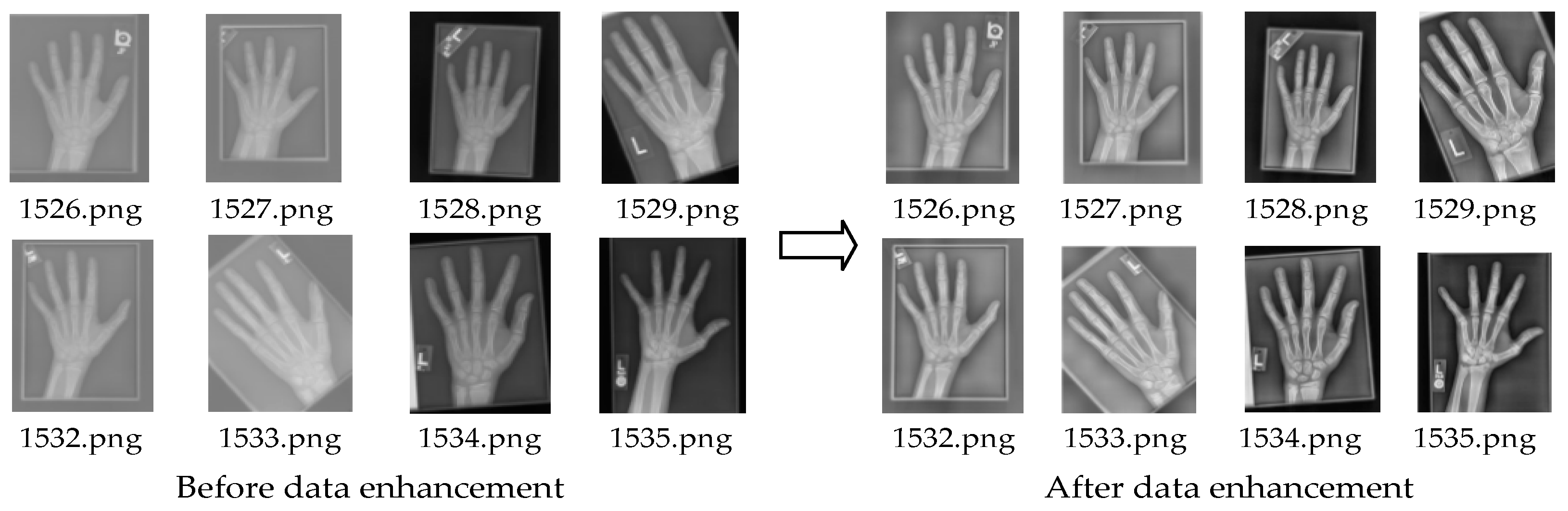 Symmetry-Based Fusion Algorithm for Bone Age Detection with YOLOv5 and ResNet34