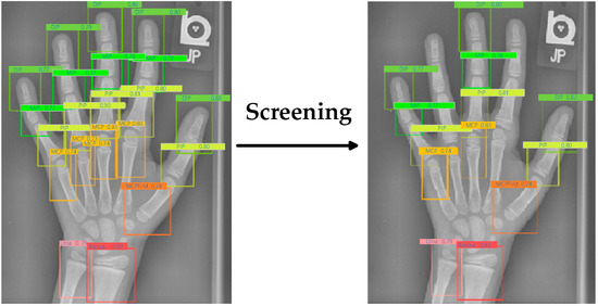 Symmetry-Based Fusion Algorithm for Bone Age Detection with YOLOv5 and ResNet34