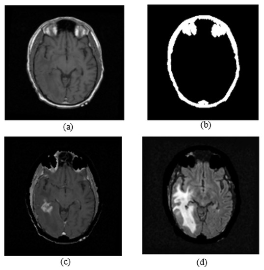 Symmetry | Free Full-Text | Automatic Brain Tumor Detection and Volume ...