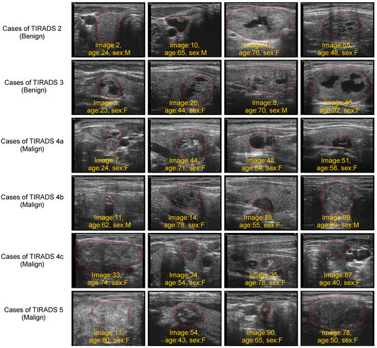 Systems | Free Full-Text | AI in Thyroid Cancer Diagnosis: Techniques ...