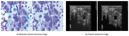 Systems | Free Full-Text | AI in Thyroid Cancer Diagnosis: Techniques, Trends, and Future Directions