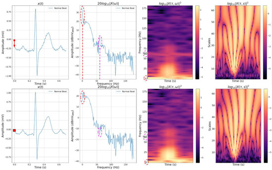 Preprocessing Selection For Deep Learning Classification Of Arrhythmia Using Ecg Time Frequency