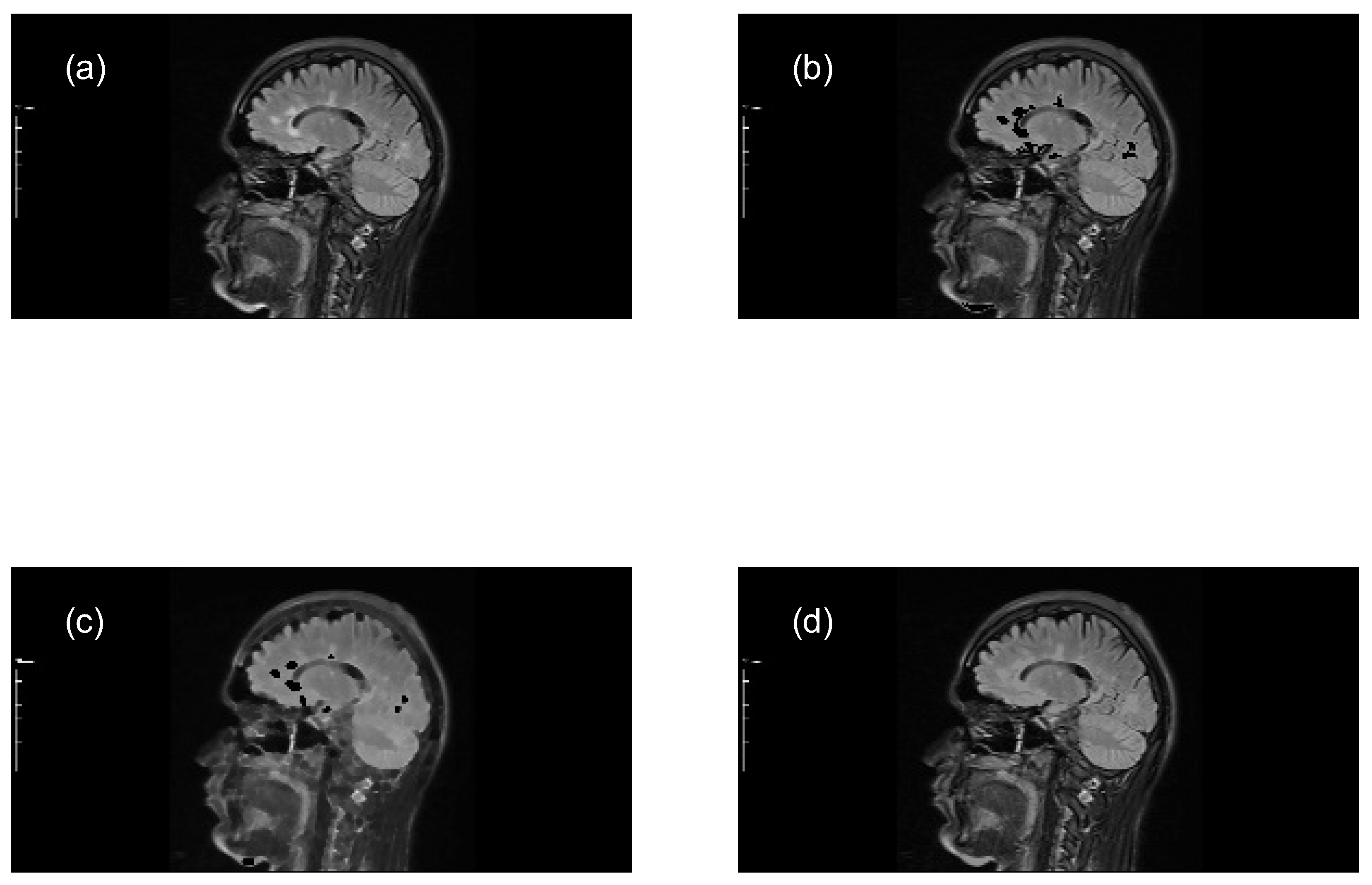 Training Artificial Neural Networks to Detect Multiple Sclerosis Lesions Using Granulometric ...