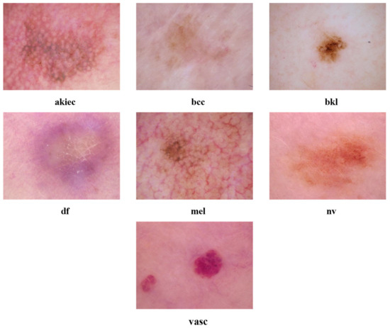 A Hybrid Trio-Deep Feature Fusion Model for Improved Skin Cancer ...