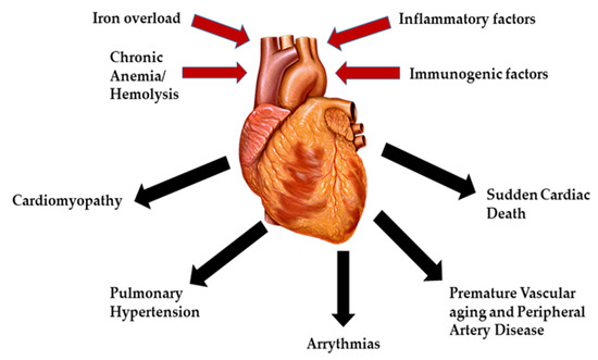 Thalassemia Reports Free Full Text Cardiovascular Complications In