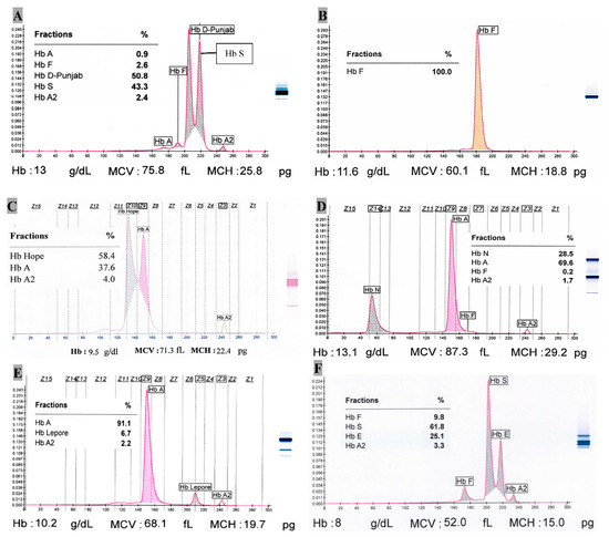 Spectrum of Thalassemia and Hemoglobinopathy Using Capillary Zone ...