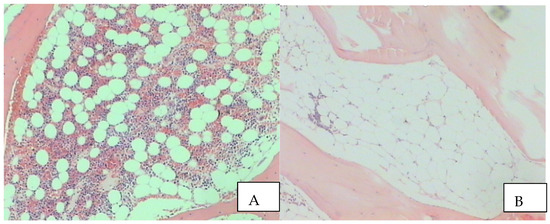 The Benign Clone Causing Aplastic Anaemia