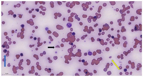 A Case Report of Hyperhemolytic Syndrome in Sickle Cell Disease, with a ...