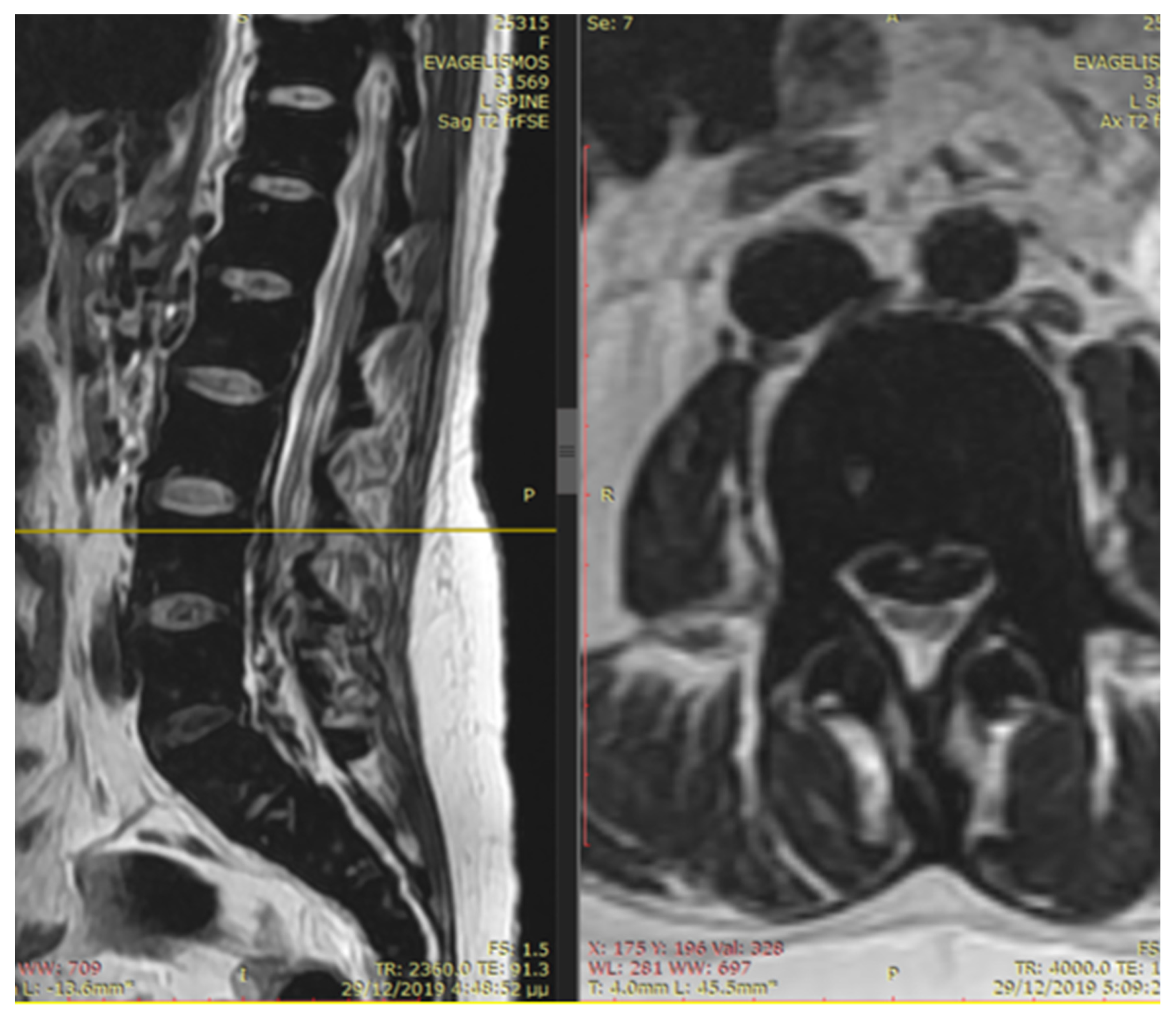 Unveiling Extramedullary Hematopoiesis: A Case Report Highlighting the ...