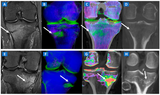 Identification of Non-Traumatic Bone Marrow Oedema: The Pearls and Pitfalls of Dual-Energy CT (DECT)